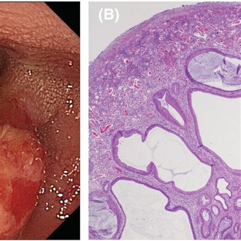 A Pedunculated Polyp In The Lower Rectum B Photomicrograph Of The Download Scientific