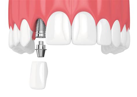 Accuracy Of The Anterior Single Tooth Implant Vital Specialists In