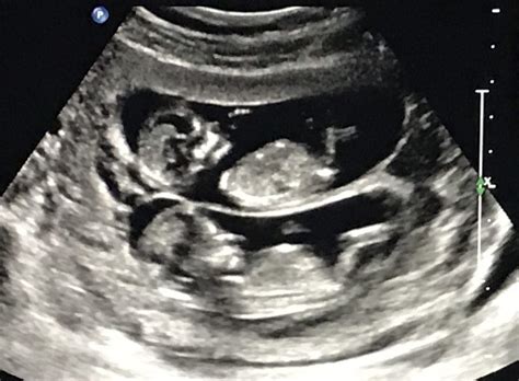 Identical Twins Ultrasound Weeks