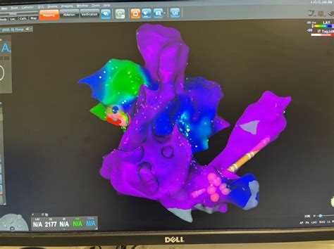 Long Persistent Afib Diagnosis Was Terminated By One Ablation Point 31 Y Old Woman Suffered