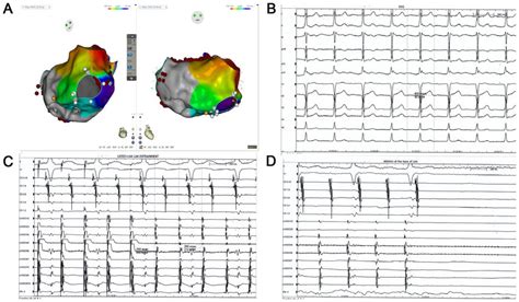 A 67 Year Old Male Patient With Persistent Atrial Fibrillation Download Scientific Diagram