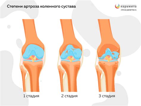 Артроз коленного сустава (гонартроз) - симптомы, степени и лечение