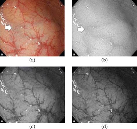 A Original Rgb Endoscopic Image B R Plane C G Plane D B Plane Download Scientific Diagram