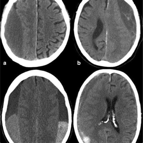 Chronic Subdural Hematoma Classification Mixed Hyperdense