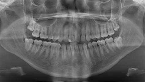 teeth segmentation3 instance segmentation dataset by md anas