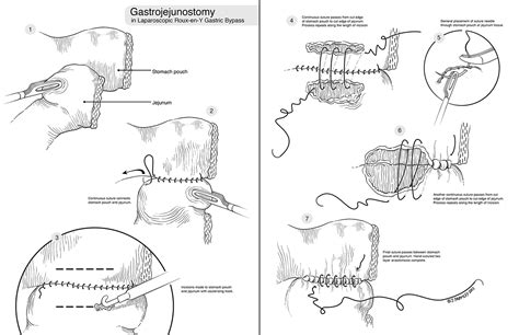 Gastrojejunostomy On Behance