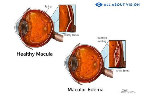 Cystoid Macular Edema