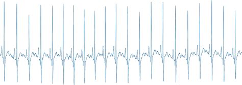 Evaluation Of Electrocardiogram Numerical Vs F1000research