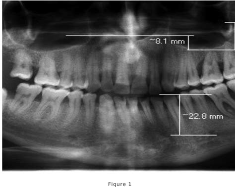 Figure 1 From Tooth Extraction As A Risk Factor For Maxillary Sinus Pneumatization A Case
