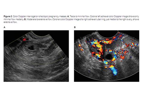 BÀi SoẠn VỀ SiÊu Âm ChẨn ĐoÁn Adnexal Findings In Ectopic Pregnancy