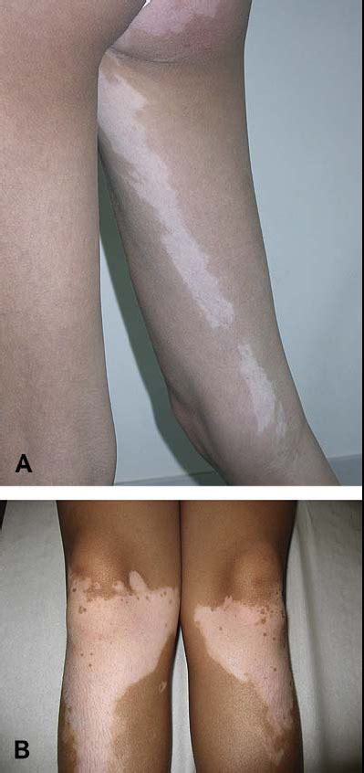 Segmental And Non Segmental Vitiligo Explained