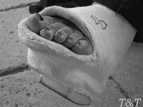 Plaster Walking Cast SLWC