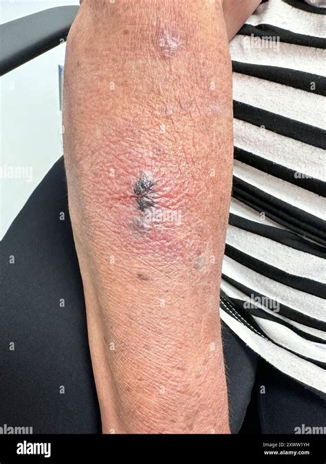 Telangiectasia Macularis Eruptiva Perstans Tmep Lesion On A Hispanic Female Patients Arm