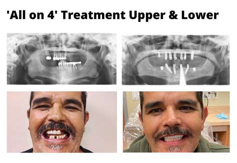 Zygomatic And Pterygoid Implants Temecula Dental Implants And Oral Surgery