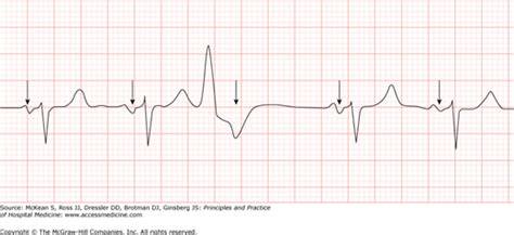 Ventricular Arrhythmias Anesthesia Key