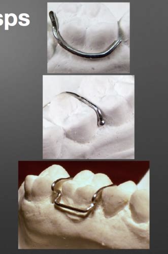 423 Interim Partial Denture Flashcards Quizlet