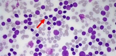 Solved These Malignant Cells Seem To Have Mixed Morphology Chegg