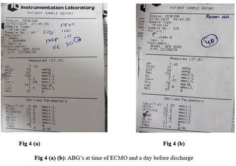 Ecmo The Last Resort For Refractory Beta Blocker Overdose Kauvery