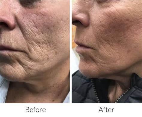 Subcision For Acne Scar Revision In Manchester NH