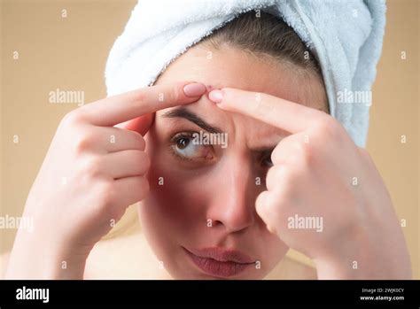 Close Up Woman Squeeze Out Pimples On Forehead Acne And Pimple On Skin