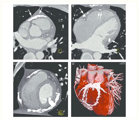 Pericardial Calcification In Transaxial Slices A And B The