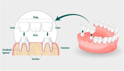 Dental Bridges Tempe Az Restore Your Smile And Bite Book Now