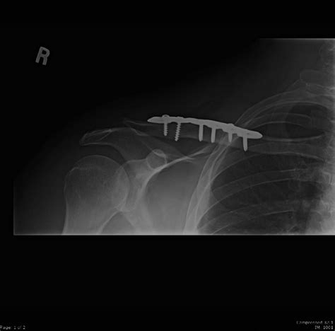 This Radiograph Taken 1 Year Postoperatively Shows The Healed