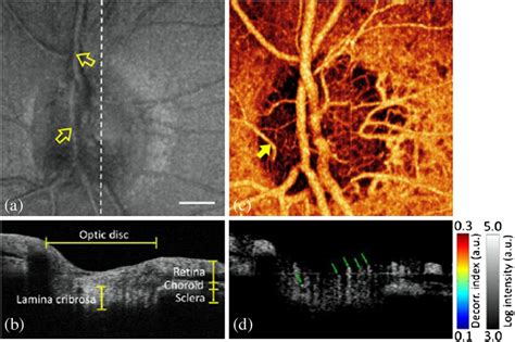 In Vivo 3 D Volumetric ONH Angiography A En Face Reflectance
