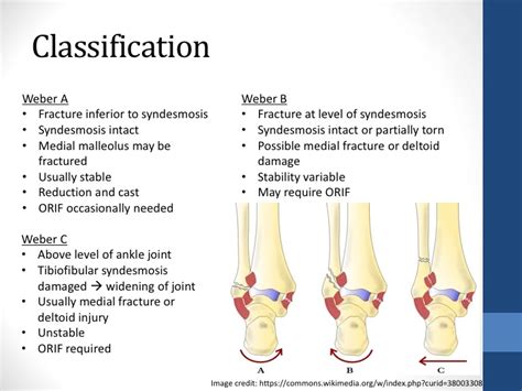 Types Of Ankle Fractures Ankle Fracture Pinterest