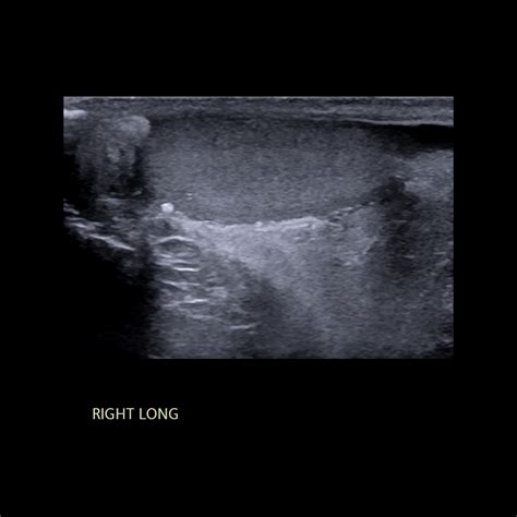 Pediatric Scrotolith Pediatric Radiology Reference Article