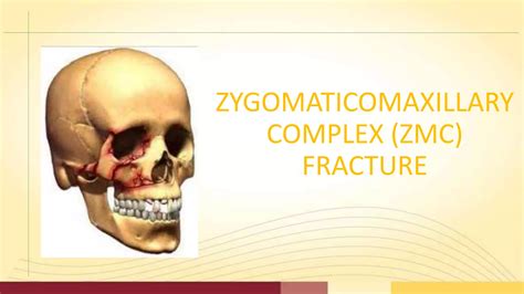Zmc Fracture Ppt