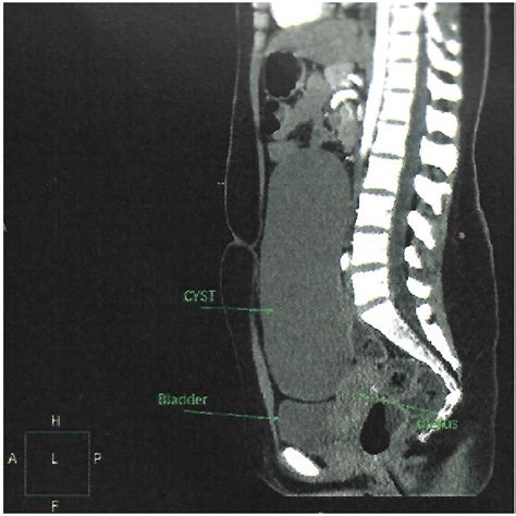A Computed Tomography Scan Showing A Thin Walled Unilocular Cyst