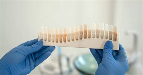 Dental Veneers A Complete Guide