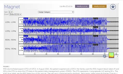 Figure 1 From Centromedian Thalamic Neuromodulation For The Treatment