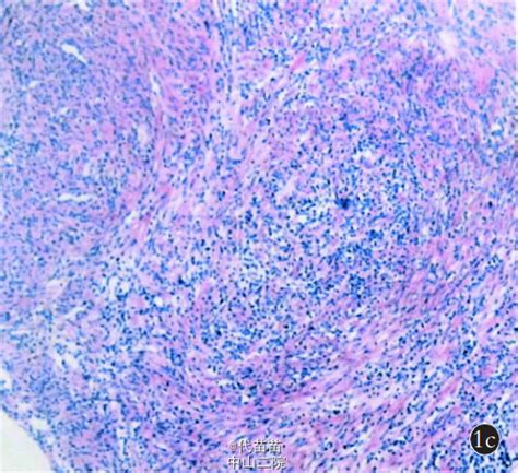 炎症性肌纤维母细胞瘤 1 例 医联