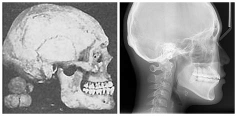 Impact Of Mastication On The Length Of The Mandibular Ramus Album On