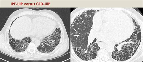 3 Signs Can Discriminate Between Uip Due To Connective Tissue Disease