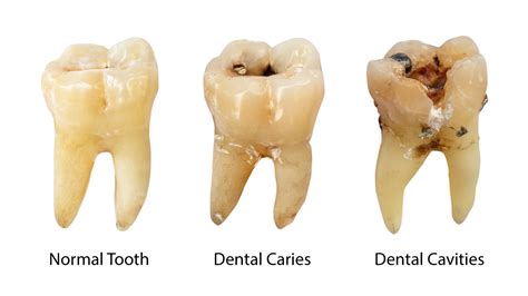 Cavity Explained At Clara Brittain Blog