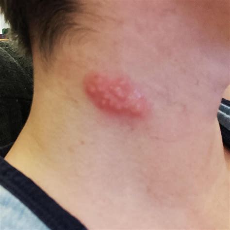 Neck Turning Red W White Bumps Itchy Stings Help Please R
