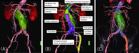Computed Tomography Angiography Cta Reconstructions In Patients 5