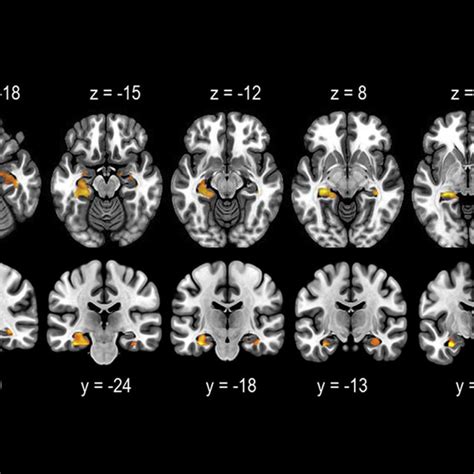 One Sample T Test Of Mesial Temporal Lobe Activation In The Whole Group