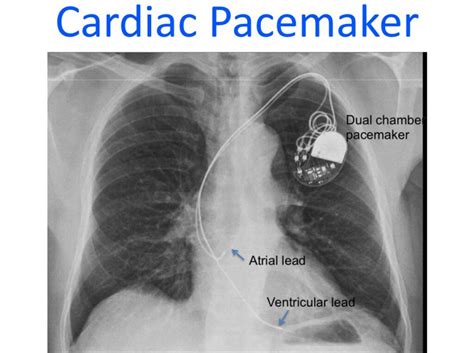 Cardiac Pacemaker Gives Regular Electrical Pulses To The Heart If Needed