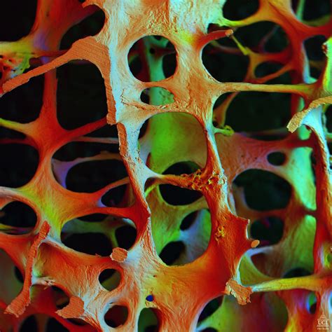 Osteoporotic Bone Bone Research Society