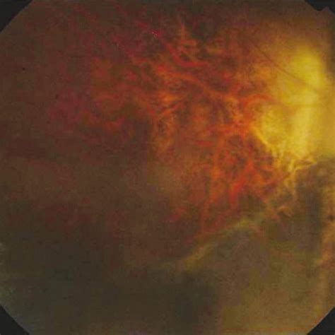 A B Fundus Photography Revealed Tilted Disk Peripapillary Atrophy Download Scientific