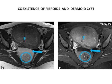Coexistence Of Fibroids And Dermoid Cyst In A 33 Year Old Woman
