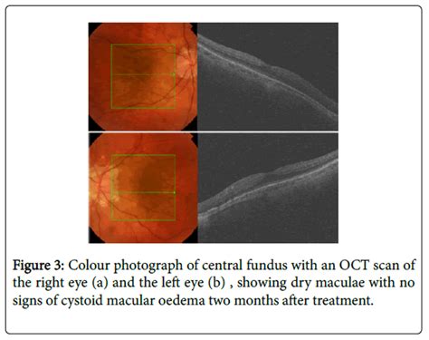 Multifocal Choroiditis With Panuveitis