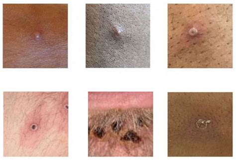 Biden Administration Declares Monkeypox A Public Health Emergency