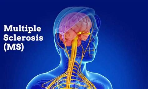 Natural Treatments For MS Philadelphia PA Patch