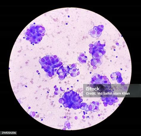 Malignant Fluid Cytology Cells Of Adenocarcinoma May Spread To Fluid Of