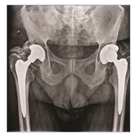 Heterotopic Ossification Visible On An Ap X Ray A And On A Computed